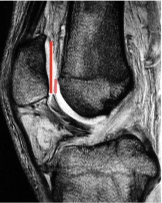 Patella Alta - Παθολογία ή παρέκκλιση - gerakasphysiotherapy.gr