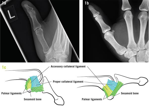 Gamekeeper's Thumb - Stener Lesion - gerakasphysiotherapy.gr