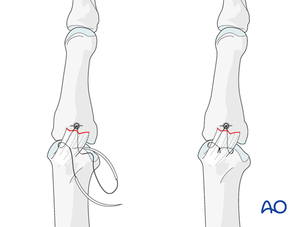 Gamekeeper's Thumb - Stener Lesion - gerakasphysiotherapy.gr