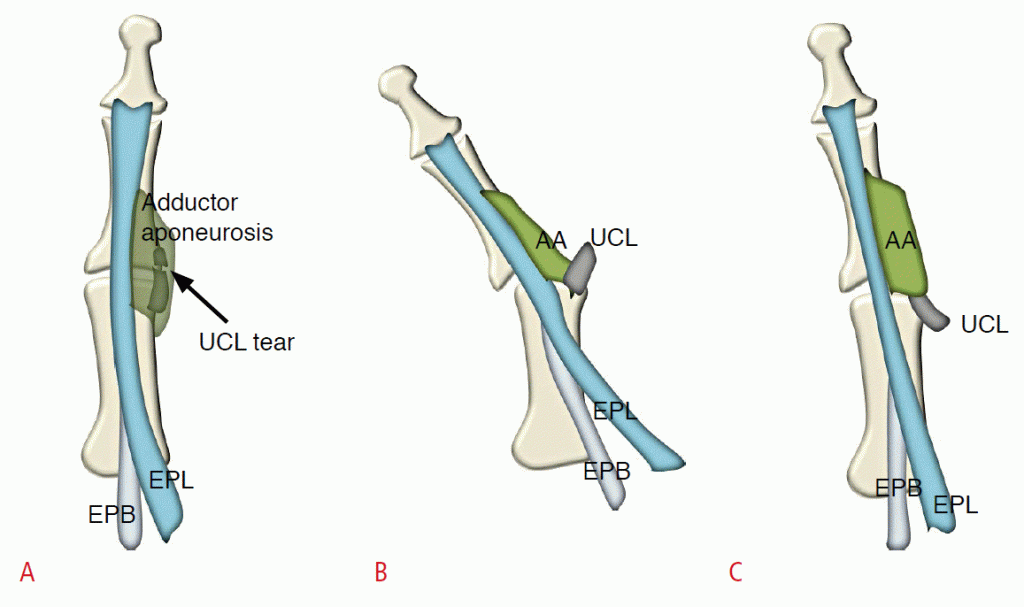Gamekeeper's Thumb - Stener Lesion - gerakasphysiotherapy.gr